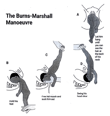 Burns Marshall Maneuver For A Breech Baby With Images