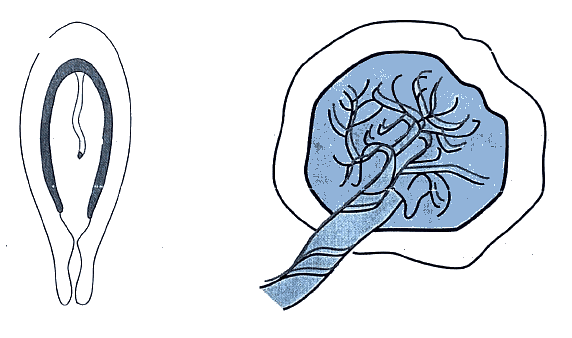 Circummarginate Placenta